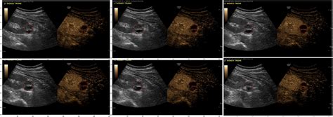 Volumetric Quantitative Contrast Enhanced Ultrasonography Evaluation Of Complex Renal Cysts An