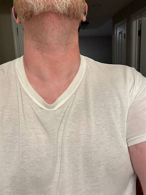 Neck Swelling R Hypocondria
