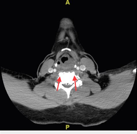 Axial View Of Ct Cervical Spine Showing Calcifications Of The Longus