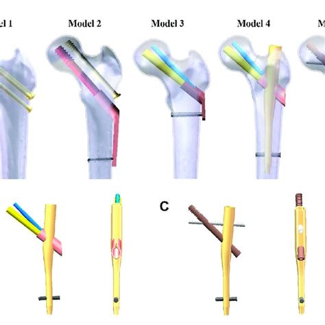 Five Different Implants After Assembly Of The Finite Element Model A