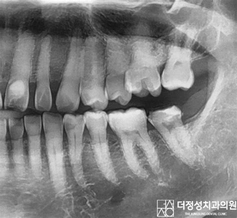 금광동 치과 깨진 치아 발치 후 즉시 임플란트 식립 케이스 네이버 블로그