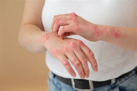 A Psoríase Não Tem Cura Mas Pode Ser Controlada Trofa Saúde