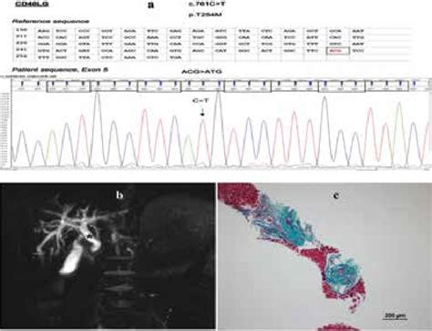 A There Is C761ct Mutation In The Cd40 Ligand Gene B Mr