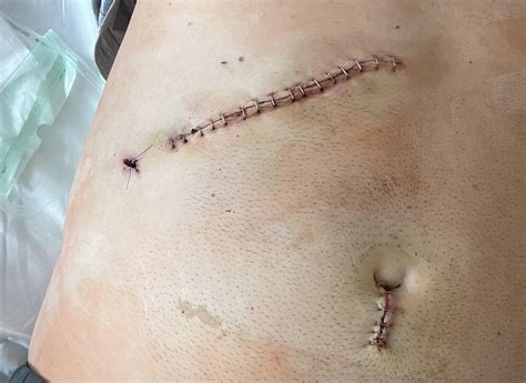 Laparoscopic Cholecystectomy Incisions