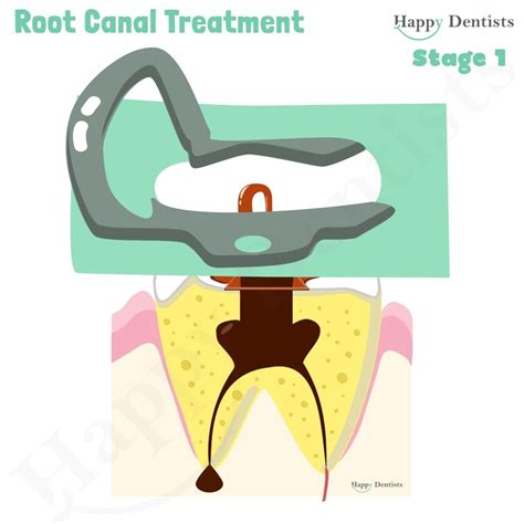Root Canal Treatment Happy Dentists