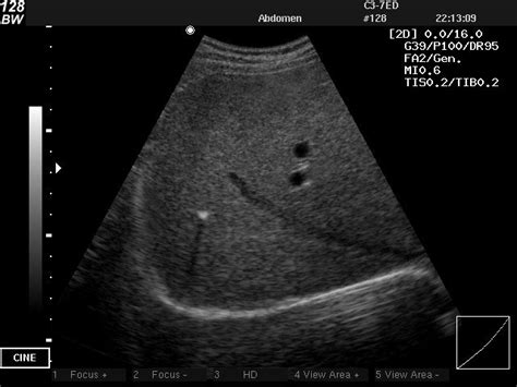 Liver Calcification Ultrasound Hot Sex Picture