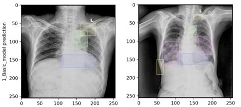 Github Arrouasserudy Chest Anomalies Detection