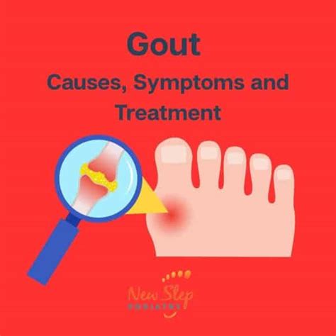 Gout In The Foot Causes Symptoms And Treatment