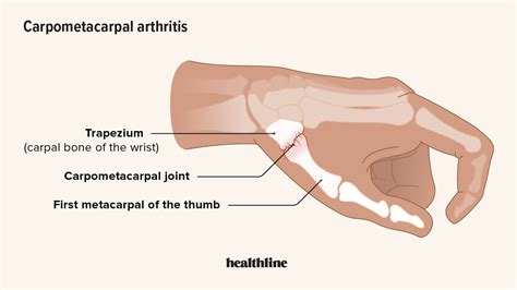 Carpometacarpal Arthritis Symptoms Causes Diagnosis And Treatment