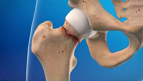 Hip Fracture Fixation Surgery Midwest Orthopaedics