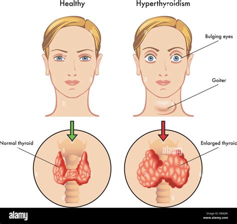 Hyperthyroidism Face