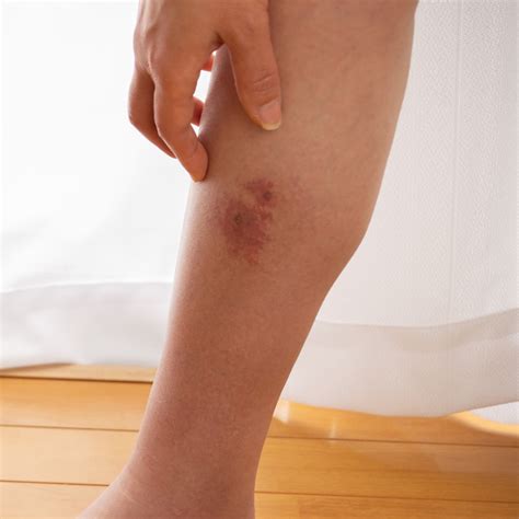 Cellulitis Pictures Symptoms Treatment Contagious Causes Types
