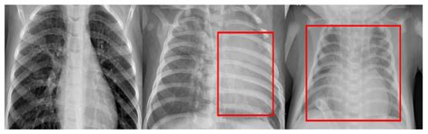Bacterial Pneumonia Chest X Ray