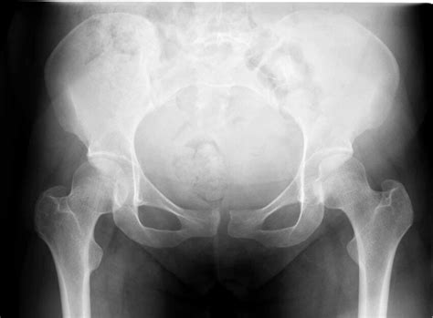 Separation Of The Symphysis Pubis Measuring About 12 Mm Sacroiliac