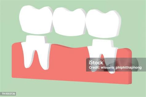 Photo Libre De Droit De Couronne Dentaire Avec Pont Processus