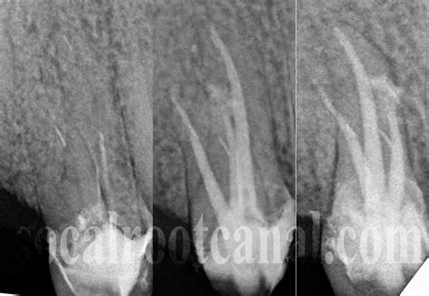 Retrieval Or Bypassing Of Broken Instruments Files Socal Root Canal