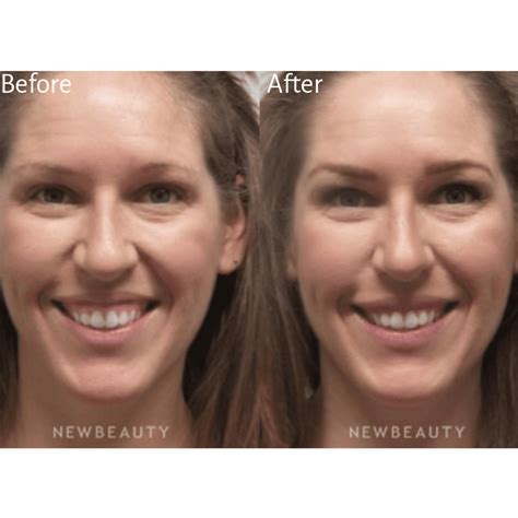 Botox Transformations Before And After Photo Gallery