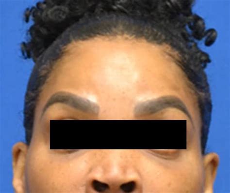 Daxxify Gallery Georgia Plastic And Reconstructive Surgery