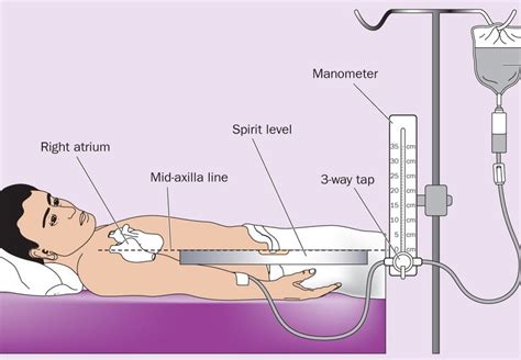 Đo Cvp Là Gì Quy Trình Thực Hiện đo Cvp Không Phải Ai Cũng Biết Nhà Thuốc Fpt Long Châu