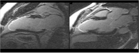 Cardiac Mri Showing Late Gadolinium Enhancement Download Scientific Diagram