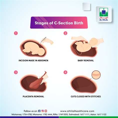 Diagram Step By Step C Section Procedure Caesarean Section