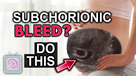 Subchorionic Hemorrhage In Pregnancy Everything To Know Youtube
