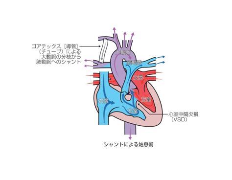 ファロー四徴症（tetralogy Of Fallot） 千葉市立海浜病院