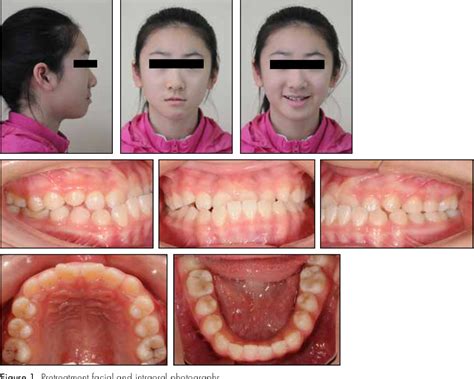 Figure 1 From An Asymmetric Magnetic Reverse Twin Block Applian Ce For