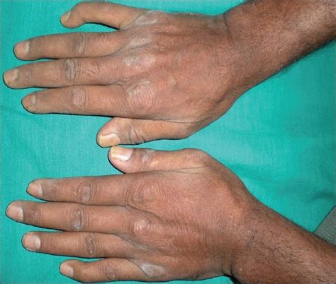 Anti Scl 70 Antibody Positive Systemic Sclerosis In A Patient With Lung