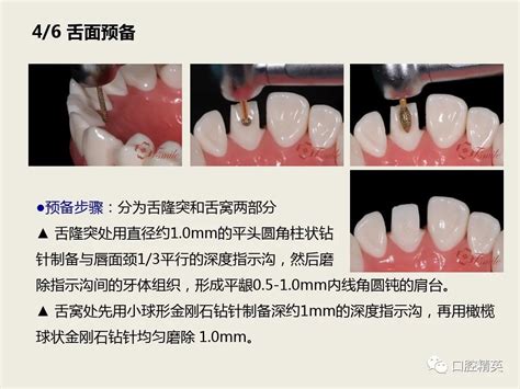 前牙全瓷冠的牙体预备 德医医学 助力医学教育发展！