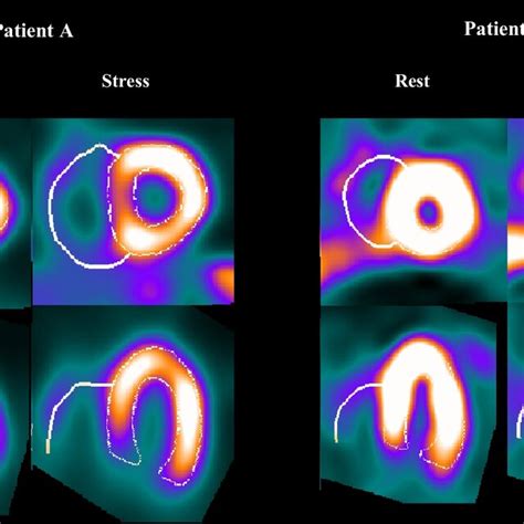 Two Sample Patients Right And Left Ventricular Segmentation By Download Scientific Diagram