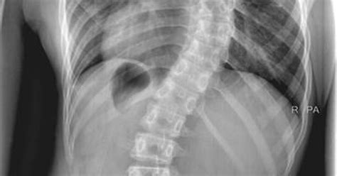 Adolescent Idiopathic Scoliosis Ais Flex Clinic