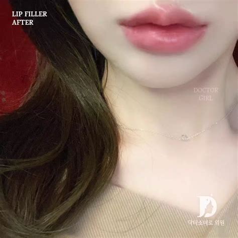 김예은 리그램 Drgirlro 입술필러 3호선 압구정역 4번출구 바로 옆 닥터소녀로의원 입술필러 💓 후기는