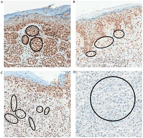 Fbxw7 Protein Expression In Cutaneous Melanoma Representative Images Download Scientific