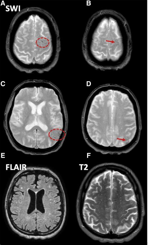 Cortical Superficial Siderosis And Transient Focal Neurological Episode Preceding Lobar