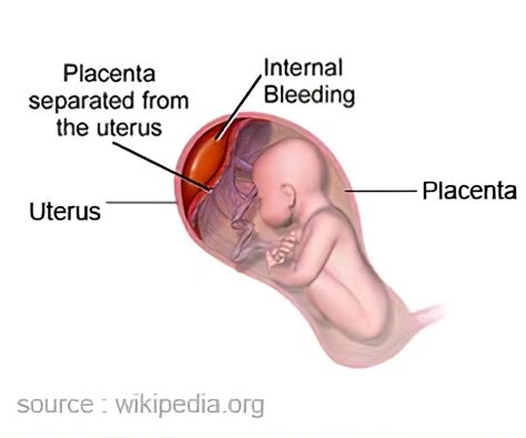 Placenta Previa Vs Abruptio