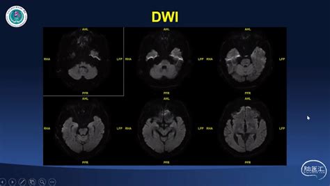 右侧椎动脉v4段串联狭窄