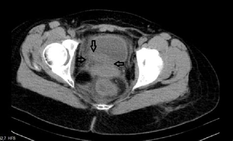 Hematoma On The Inferior Surface Of The Bladder Download Scientific Diagram