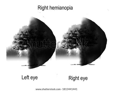 신경학적인 질병의 시각적인 결함 패턴의 다른 스톡 일러스트 1813441441 Shutterstock