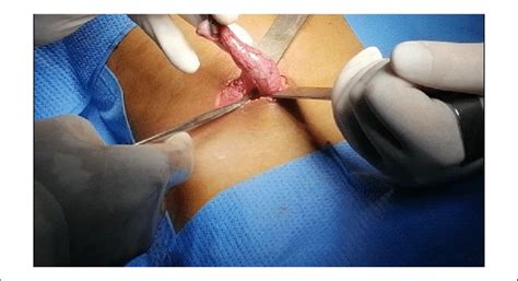 Intra Operative Image Showing The Inflamed Appendicitis Download Scientific Diagram