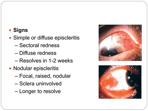 Episcleritis And Scleritis Power Point Presentations Pptx