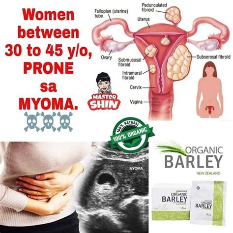 Jc Premiere Ph Mga Sintomas Ng Myoma ⛔heavy Bleeding