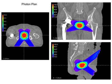 Isodose Distribution Resulting From Varian Eclipse Treatment Planning