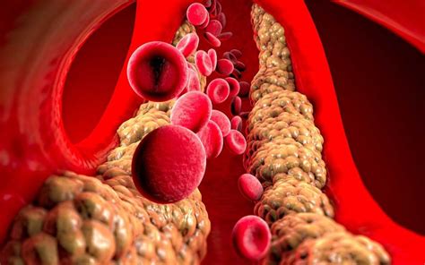 Understanding And Managing High Triglycerides Medevidence