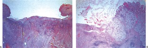 Ischemic Enteritis Abdominal Key