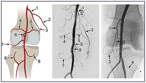 Genicular Artery Embolization A Review Of Essential Anatomic