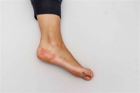 Common Foot Rashes And How To Treat Them