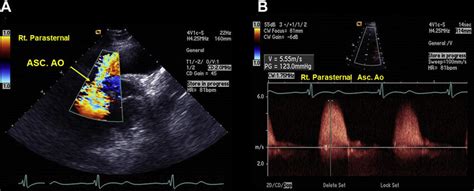 A Transthoracic Echocardiography 2D And Color Flow Doppler Download Scientific Diagram