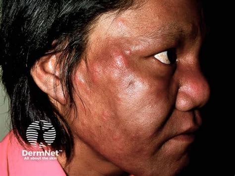 Leprosy Face Photos