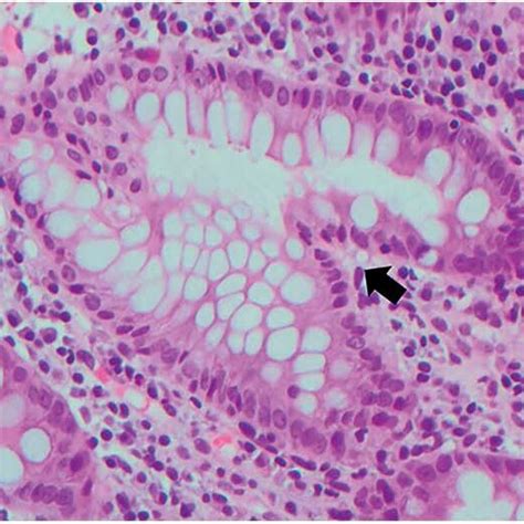 Hematoxylin And Eosin Stained Sections Of The Colonic Mucosa Showing